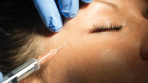 Restylane Side Effects: Understanding Potential Risks and Precautions ...