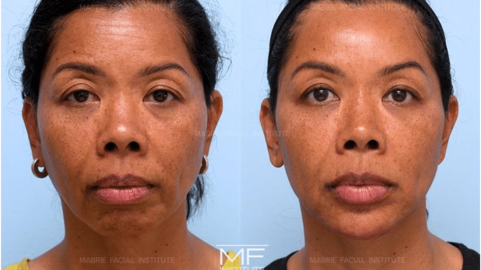 Juvederm Jowls Before and After: A Close Look - Medical SPA RX