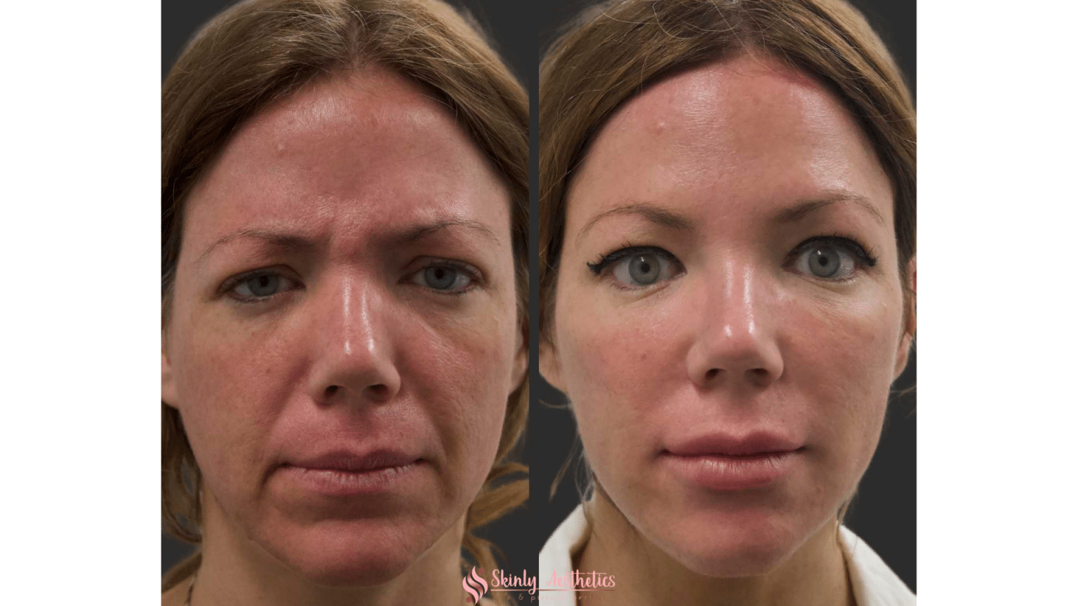 Juvederm Photos Before After: Visual Evidence - Medical SPA RX