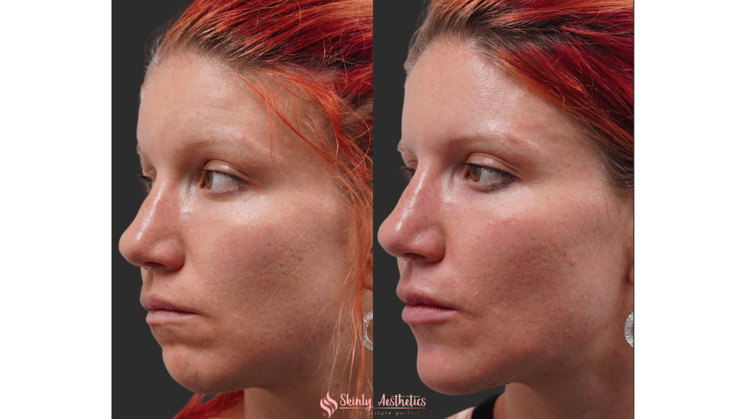 Juvederm Photos Before After: Visual Evidence - Medical SPA RX