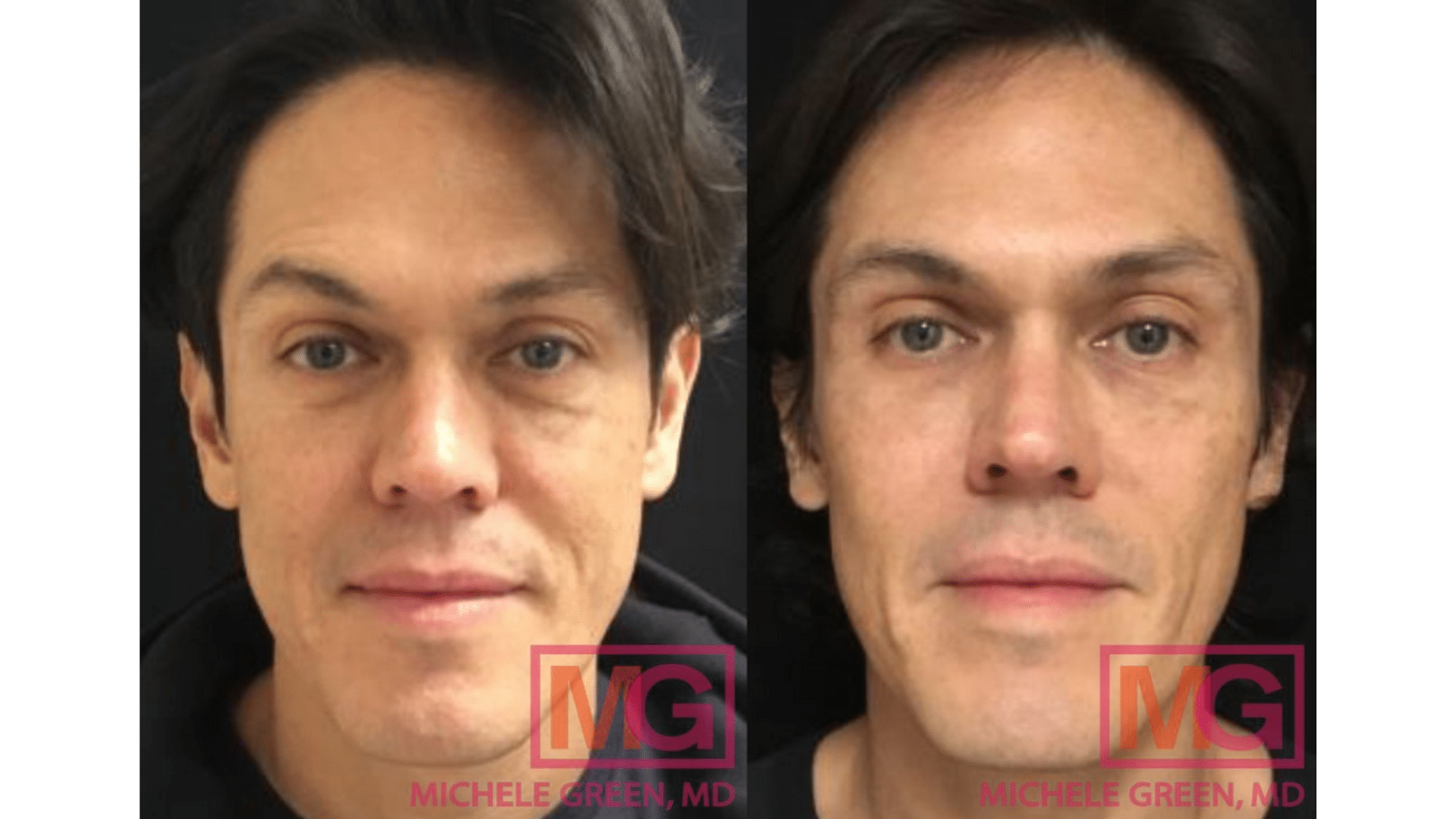 Juvederm Eyes Before and After: How Does It Work? - Medical SPA RX