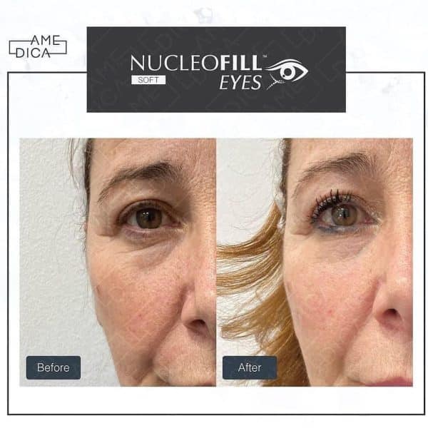 Polynucleotides Before and After - With Photo Gallery - Medical SPA RX