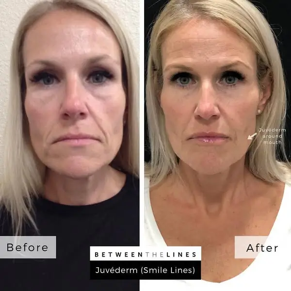 Facial Fillers Before and After – With a Photo Gallery - Medical SPA RX