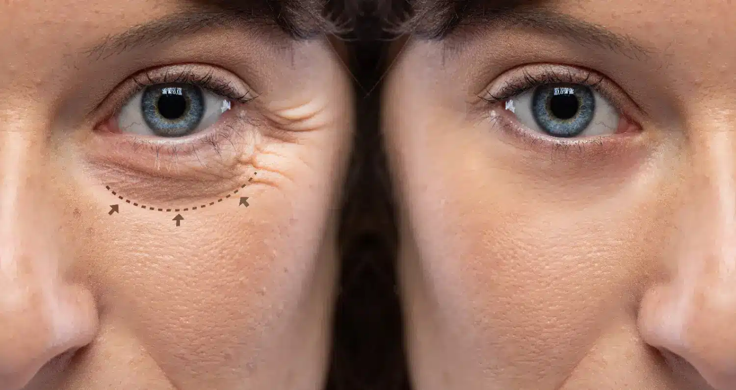 Intraline One for Tear Troughs – How Effective Is It? - Medical SPA RX