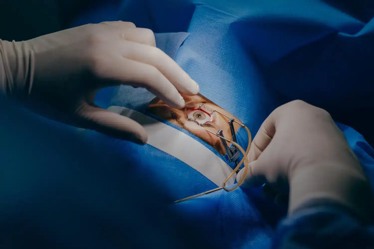 Vabysmo vs Eylea – Differences and Similarities Explained - Medical SPA RX